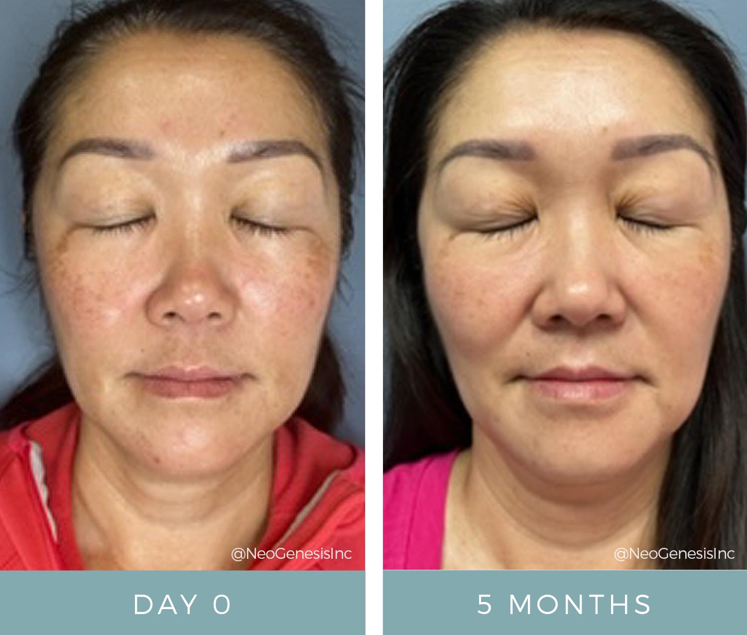 Achieving Radiant Skin for Melasma, Sun Damage, and PIH
