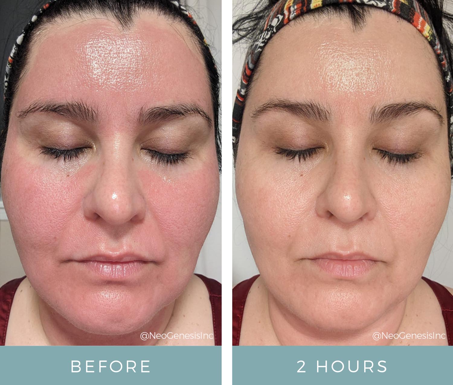 Microneedling + NeoGenesis Products Before + After Photos
