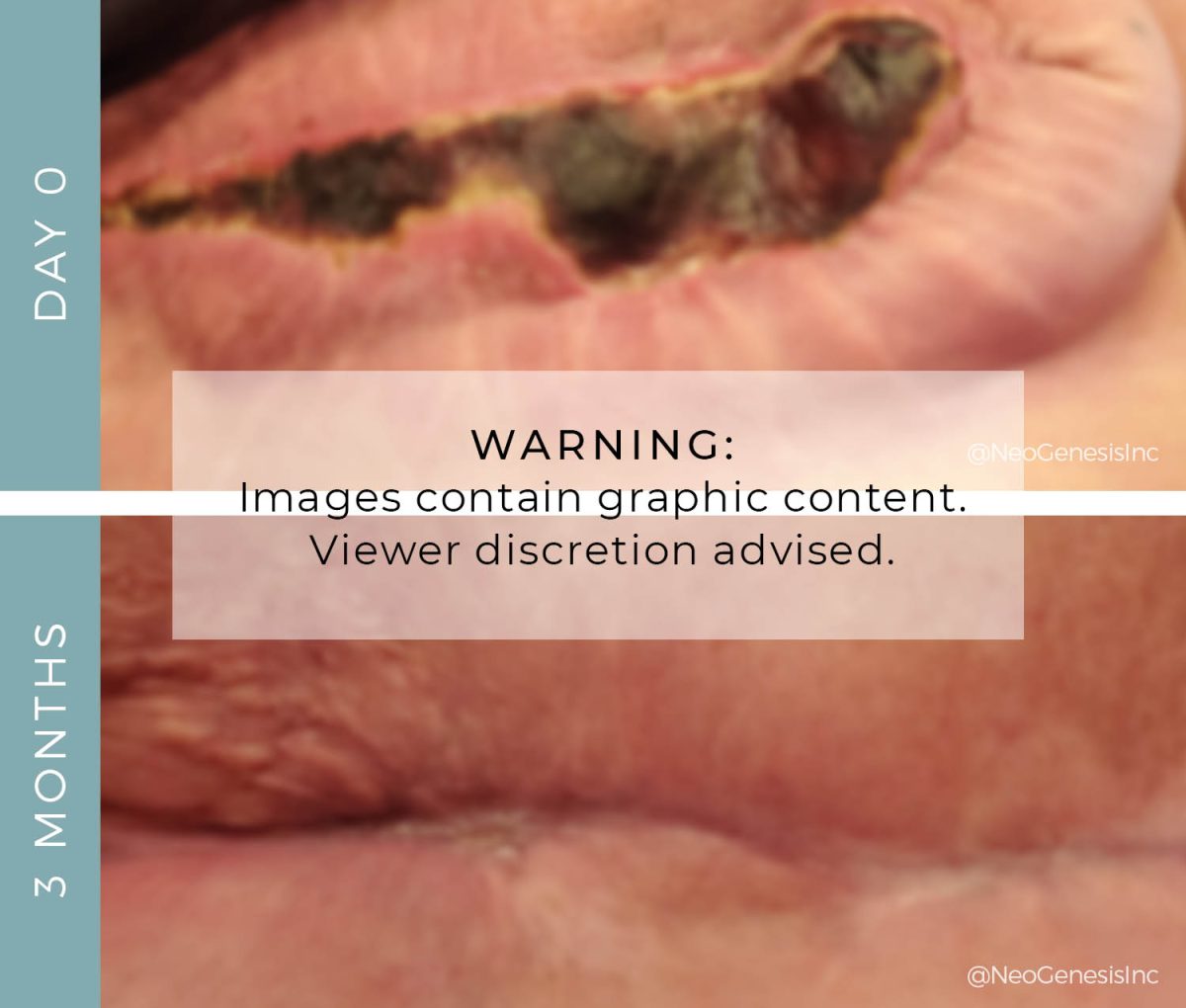 Preventing Necrosis: The Key to Mastectomy Recovery