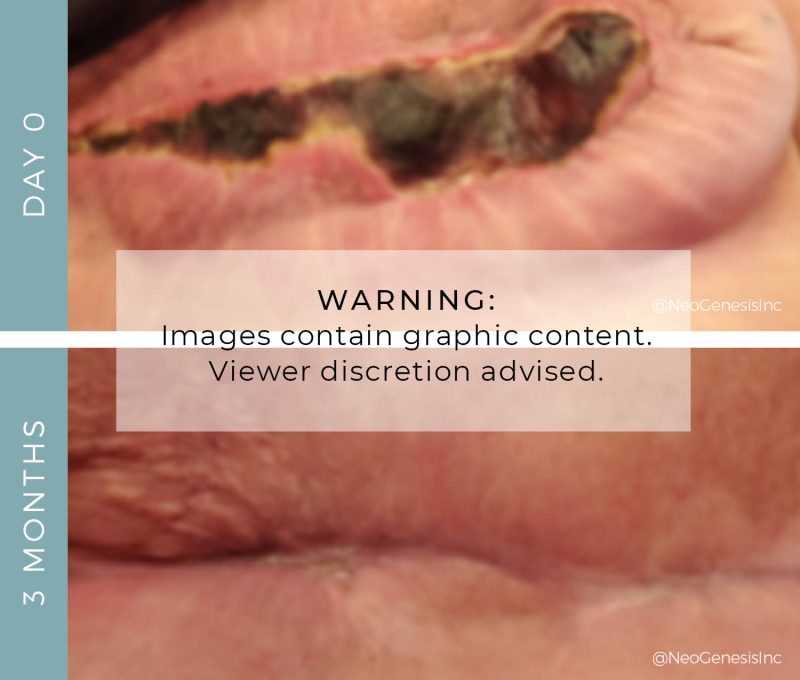 Preventing Necrosis: The Key to Mastectomy Recovery