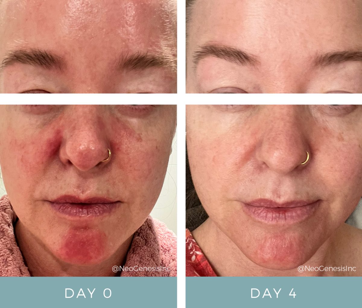 Perioral Dermatitis: Soothe and Calm Irritated Skin