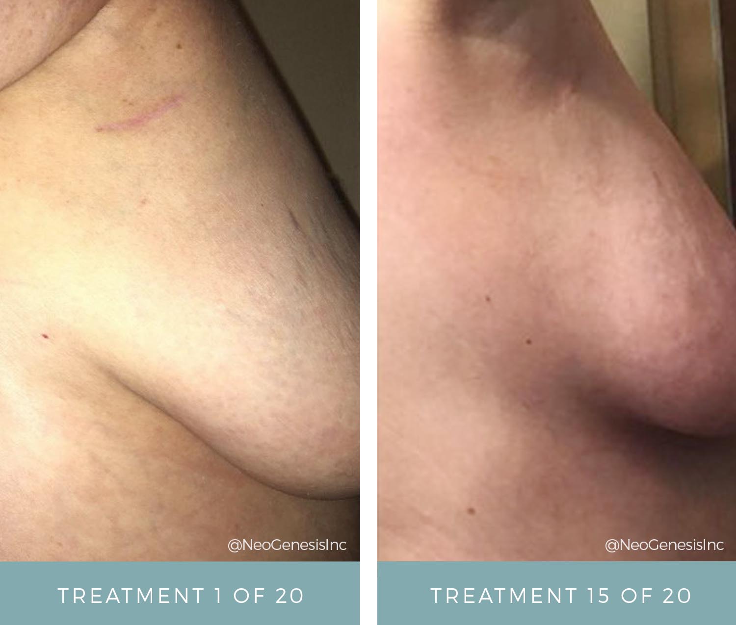 Radiation Breast Cancer Before After Testimonial NeoGenesis