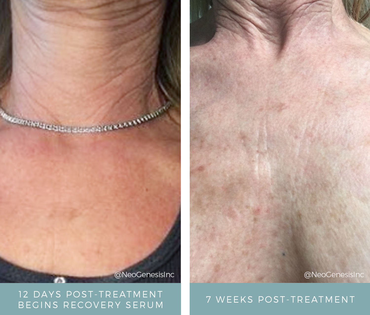 Radiation Side Effects with Lupus Before + After Photos Testimonial