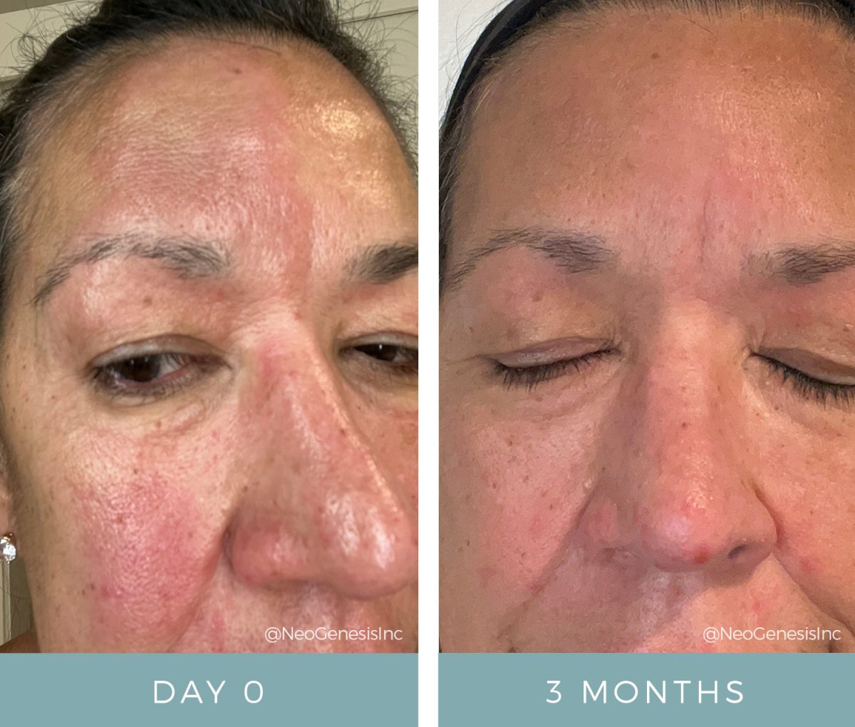 Rosacea + Seborrheic Dermatitis Before + After Photos