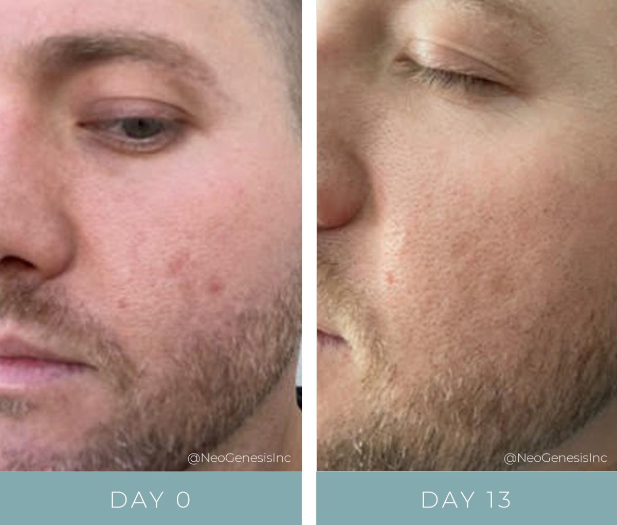 Laser Burn Scarring Skin Care Products by NeoGenesis