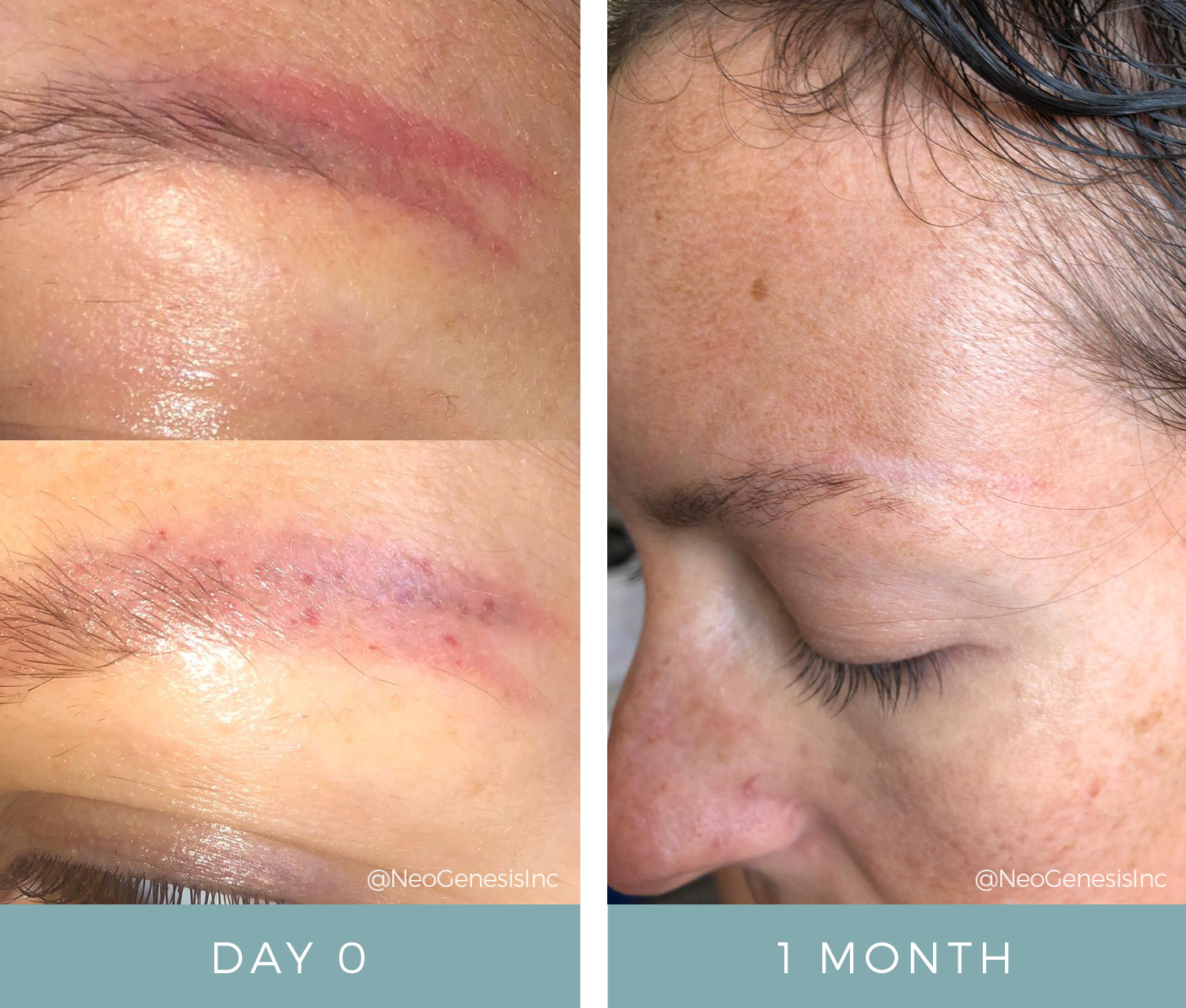 How to Minimize Scarring After Micropigmentation Brow Removal