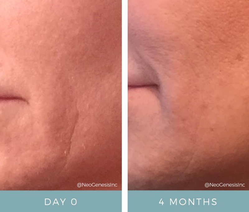 Radio Frequency Scars Transformation with NeoGenesis Products