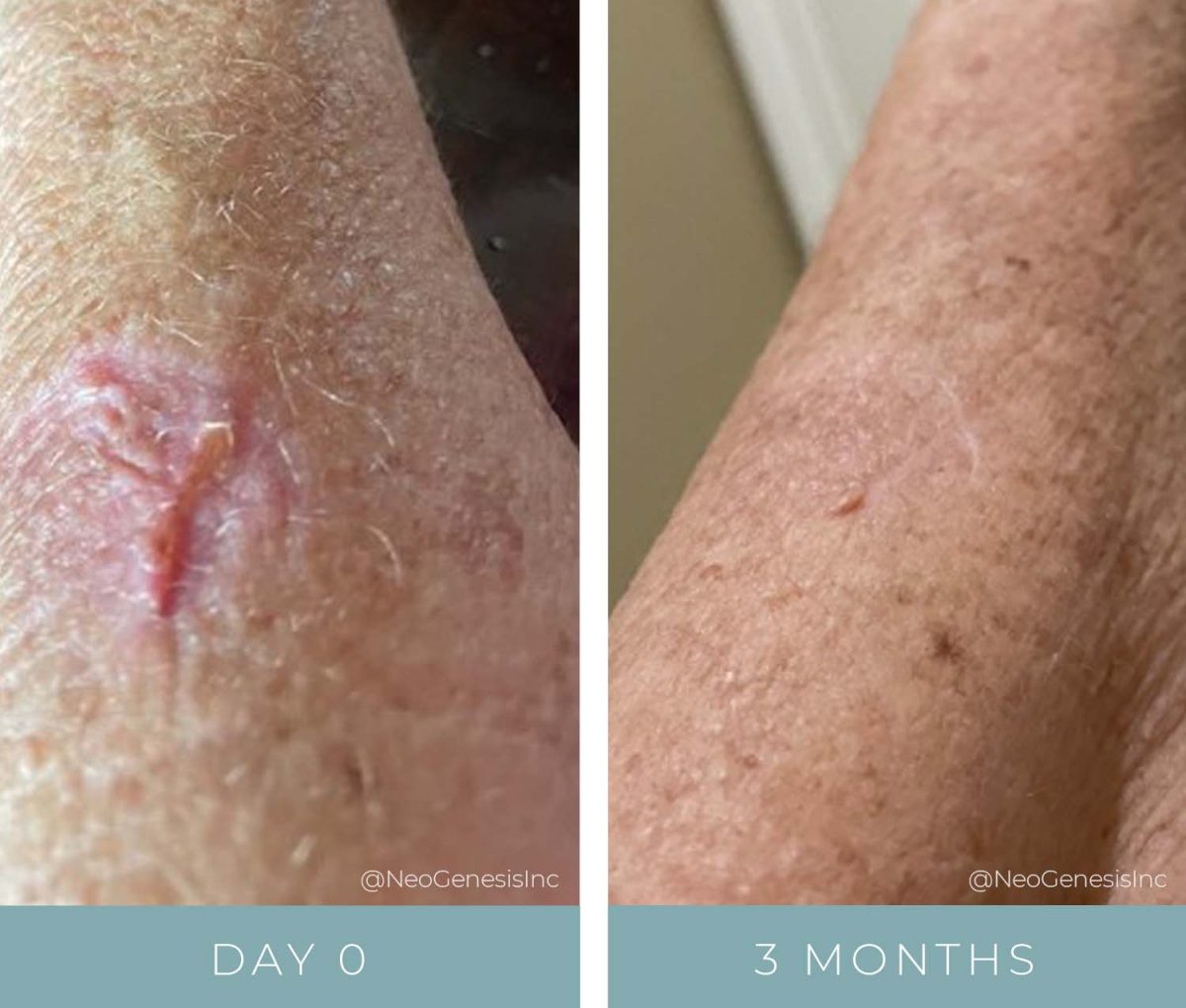 Scarring Reduction Before and After Transformation