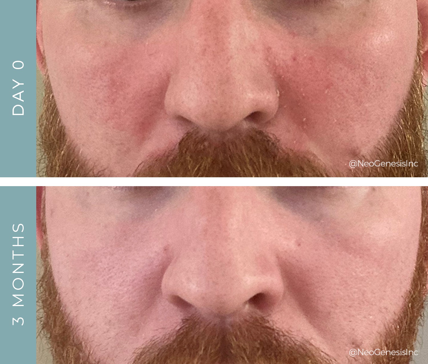 Dermatitis Exfoliativa Facial