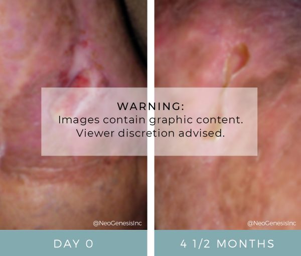 Wound Care for Diabetic Ulcers: Power of NeoGenesis Recovery