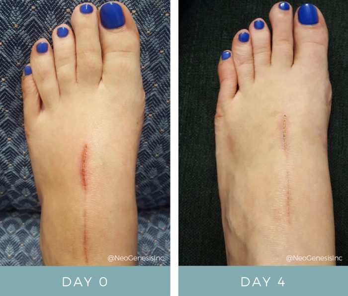 Wound Care with Stitches NeoGenesis Recovery Serum