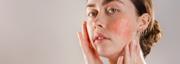 Managing Rosacea with Proper Skincare
